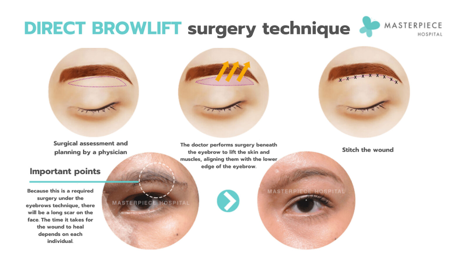 Endotine Brow Lift: Smooth Wrinkles, Brighten Eyes