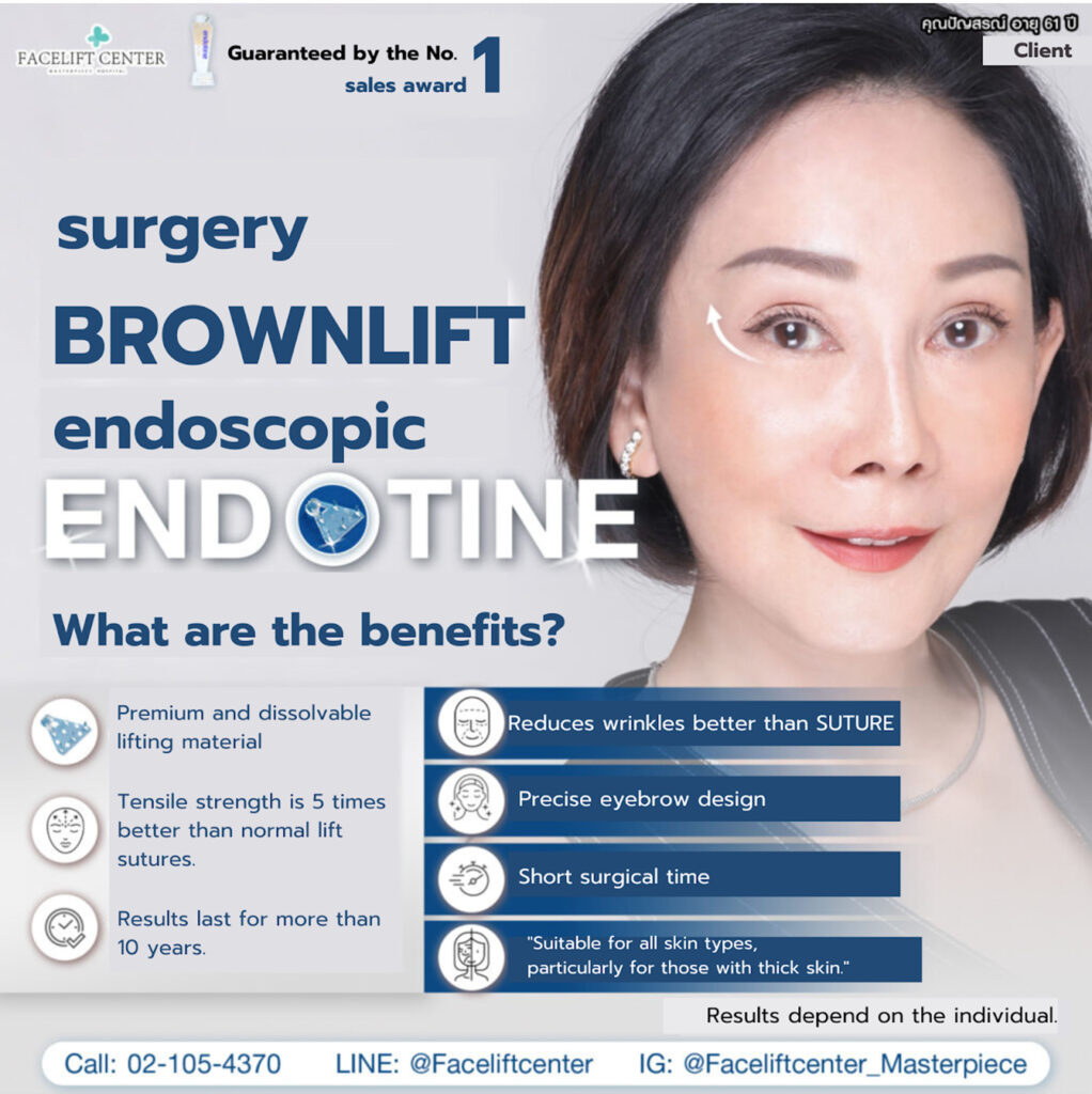 Endotine Brow Lift: Smooth Wrinkles, Brighten Eyes