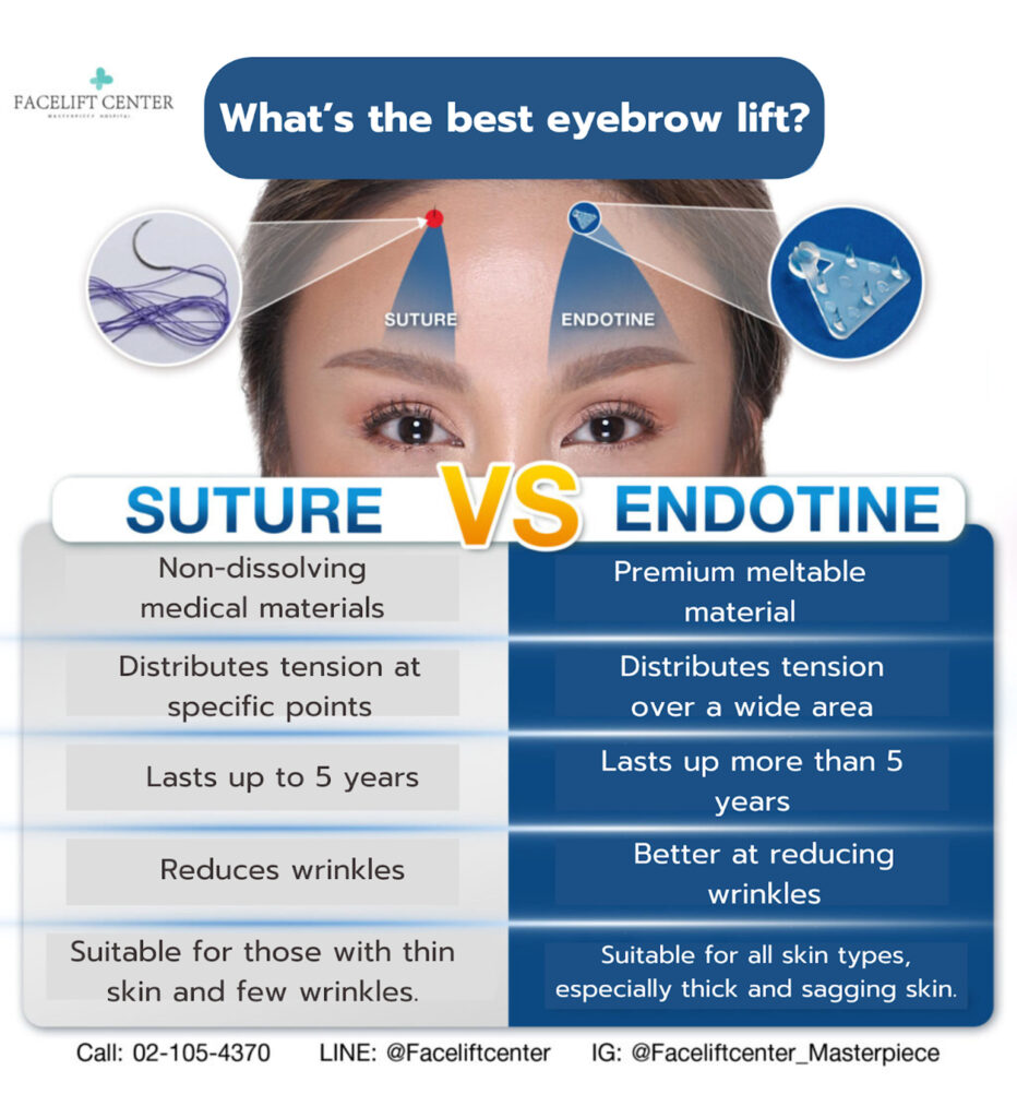 Endotine Brow Lift: Smooth Wrinkles, Brighten Eyes