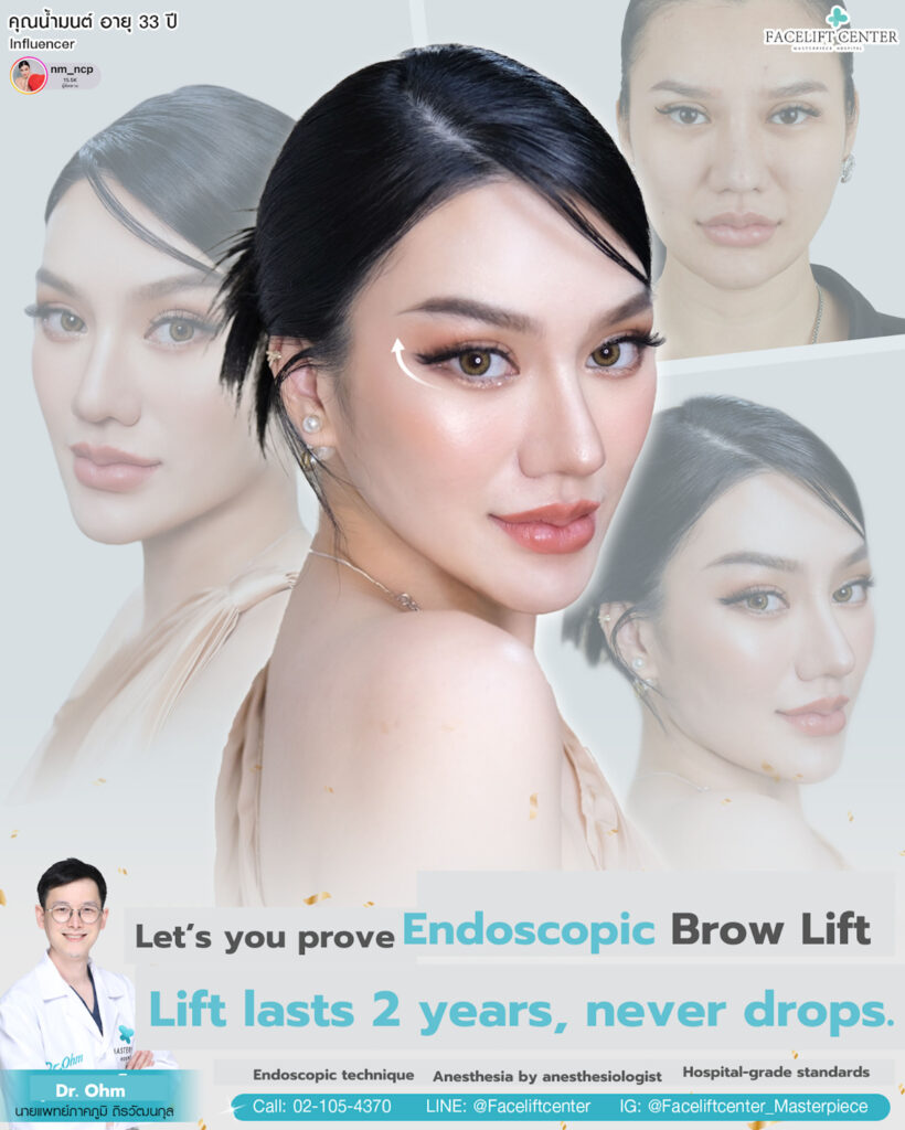 Endotine Brow Lift: Smooth Wrinkles, Brighten Eyes
