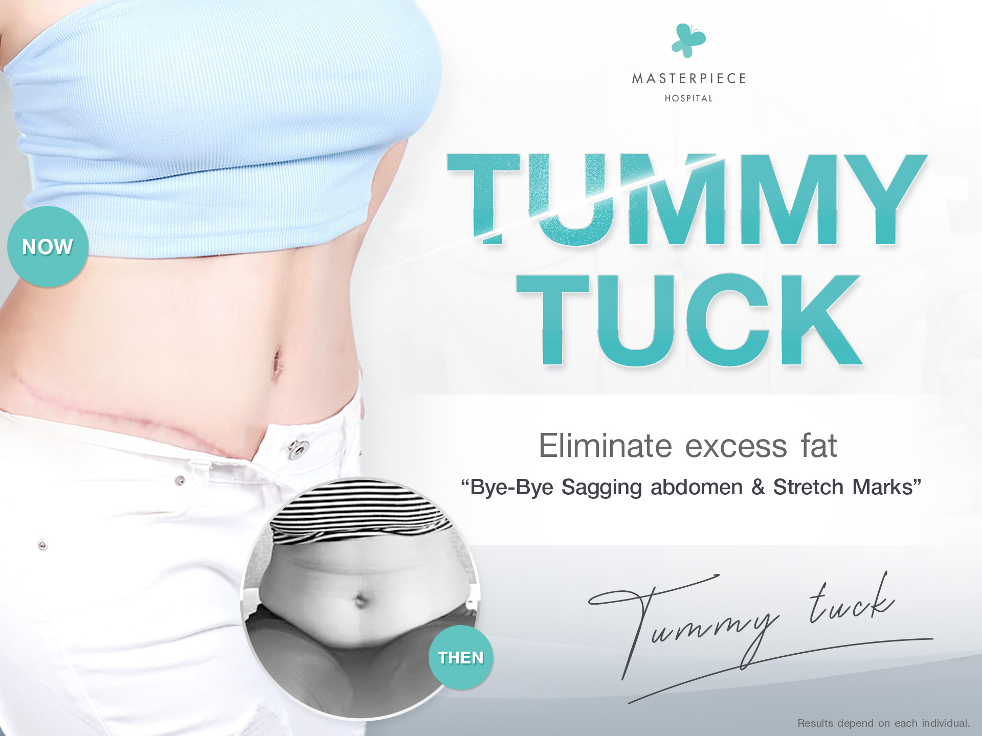 Tummy Tuck: Say Goodbye to Sagging Belly