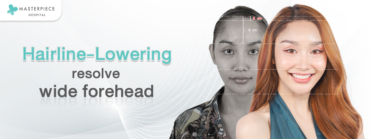 Hairline lowering reduces the forehead and fixes a wide forehead.