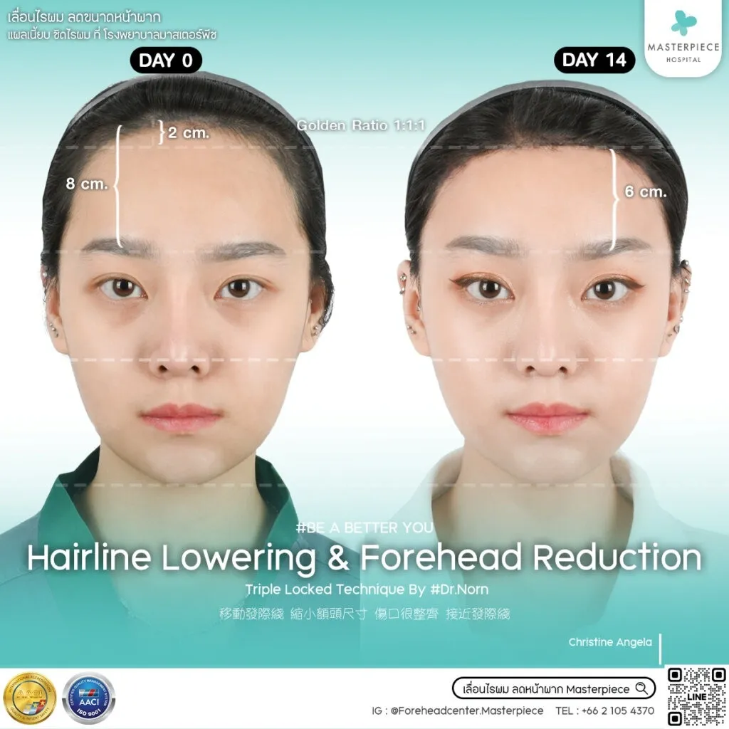 Hairline lowering reduces the forehead and fixes a wide forehead.