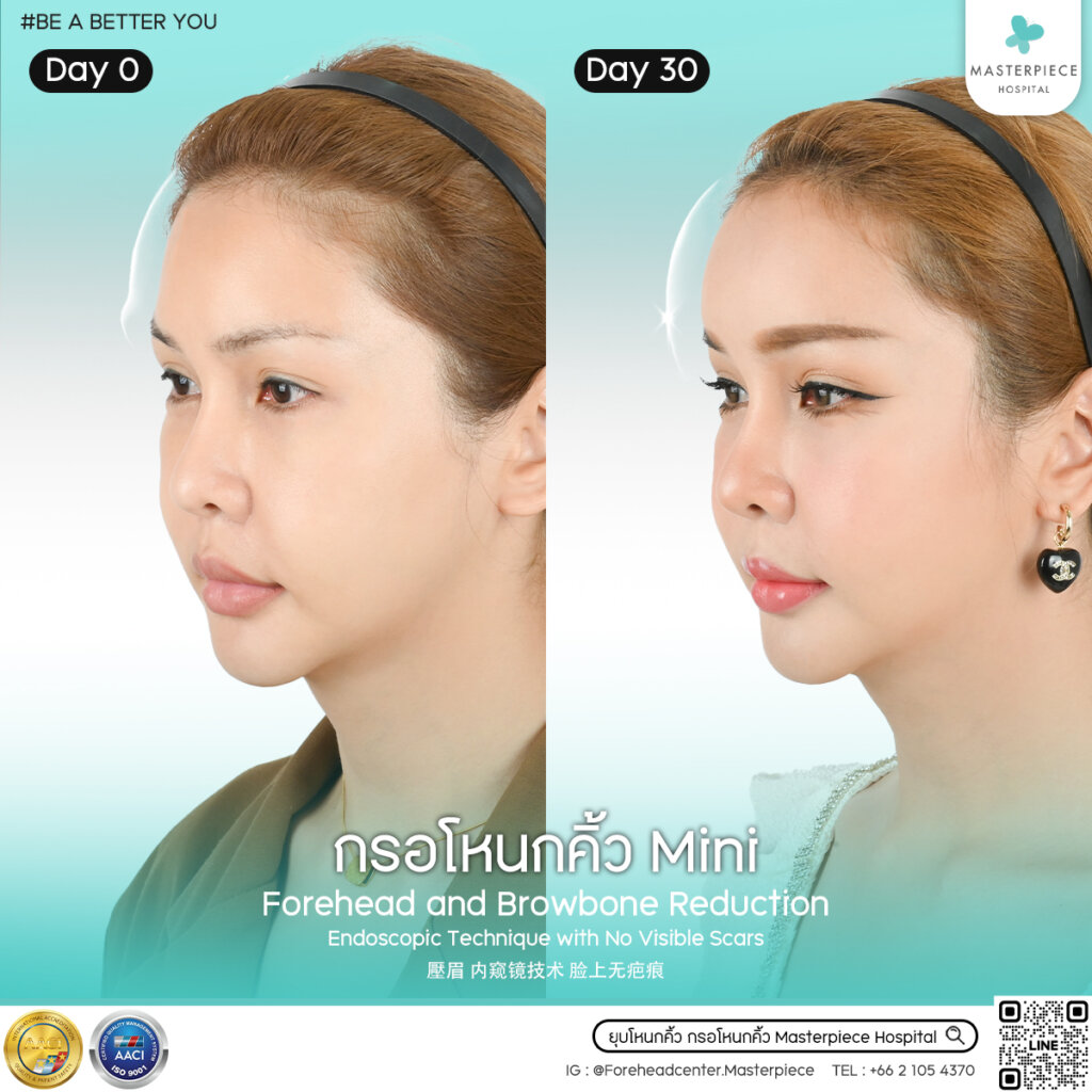 Brow Bone Reduction, Forehead Contouring, and Shaving