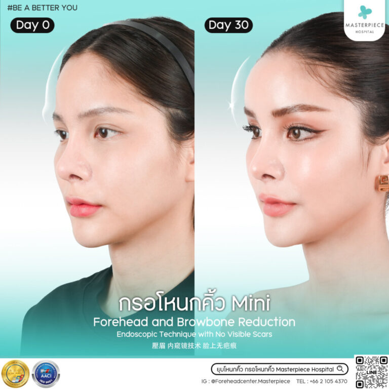 Brow Bone Reduction, Forehead Contouring, and Shaving