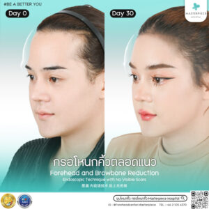 Brow Bone Reduction, Forehead Contouring, and Shaving