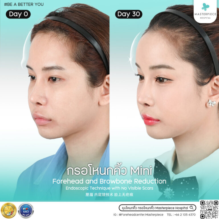 Brow Bone Reduction, Forehead Contouring, and Shaving