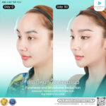 Brow Bone Reduction, Forehead Contouring, and Shaving