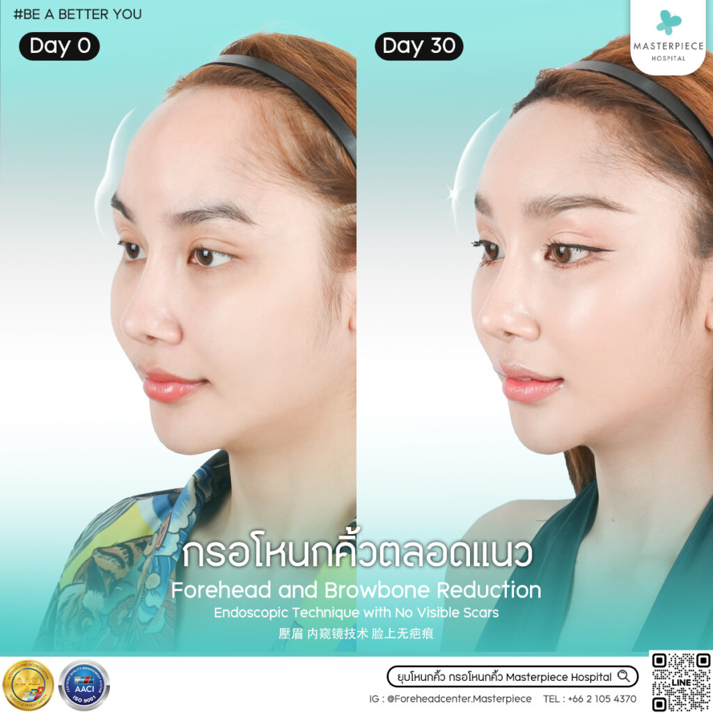 Brow Bone Reduction, Forehead Contouring, and Shaving