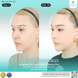 Brow Bone Reduction, Forehead Contouring, and Shaving