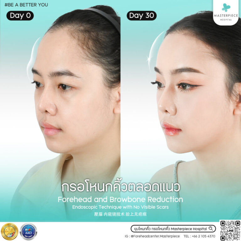 Brow Bone Reduction, Forehead Contouring, and Shaving