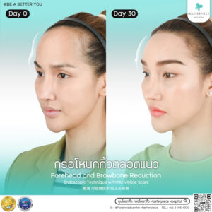 Brow Bone Reduction, Forehead Contouring, and Shaving