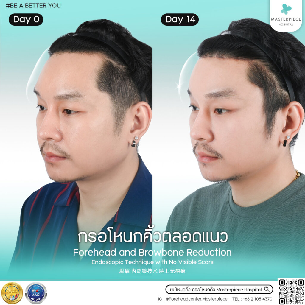 Brow Bone Reduction, Forehead Contouring, and Shaving