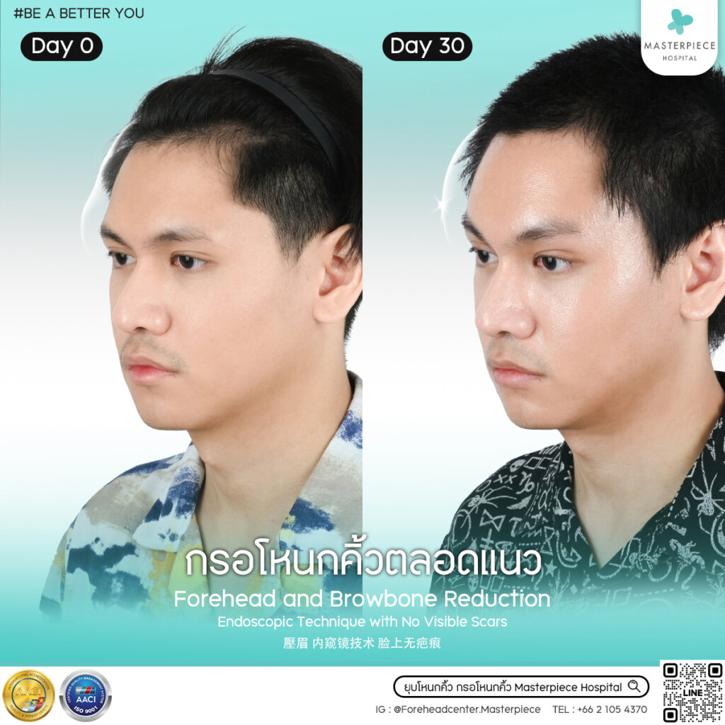 Brow Bone Reduction, Forehead Contouring, and Shaving