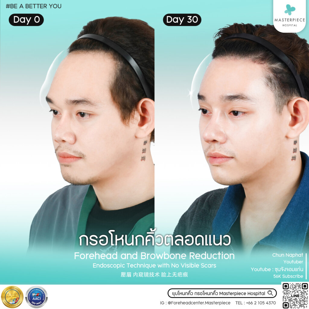 Brow Bone Reduction, Forehead Contouring, and Shaving