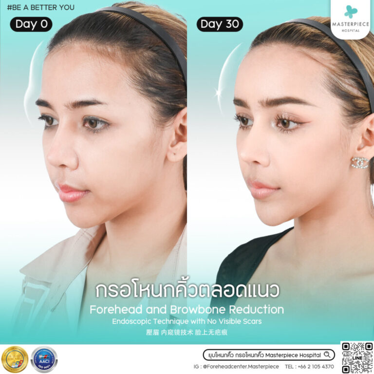 Brow Bone Reduction, Forehead Contouring, and Shaving