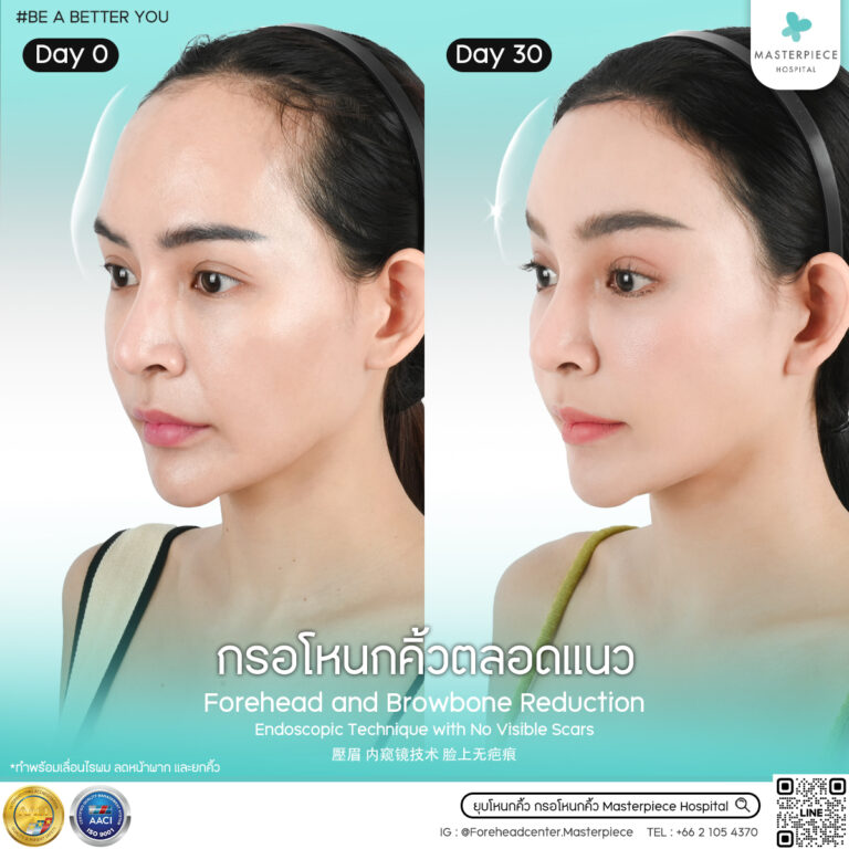 Brow Bone Reduction, Forehead Contouring, and Shaving