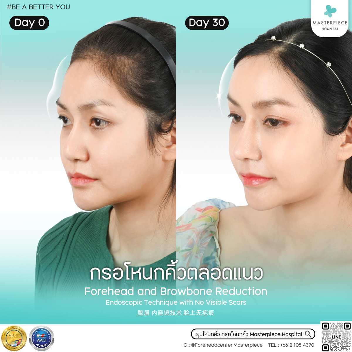 Brow Bone Reduction, Forehead Contouring, and Shaving