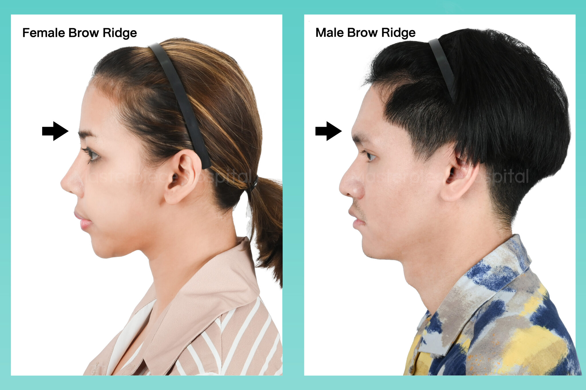 Brow Bone Reduction, Forehead Contouring, and Shaving