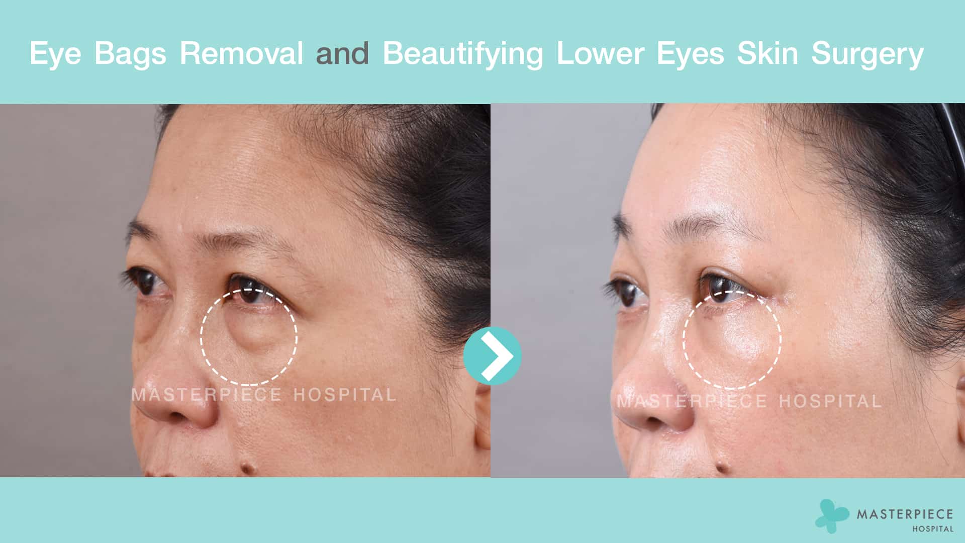 Eye Bag Removal Surgery Mexico at Oliver Gonzalez blog