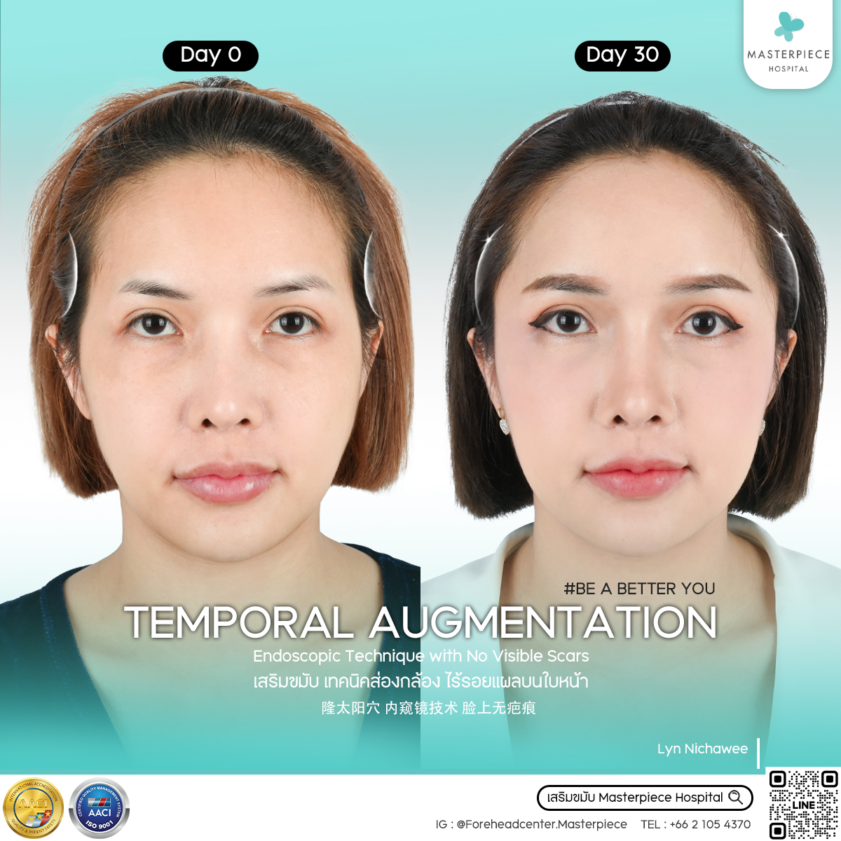 เสริมขมับ ราคาเบาๆ ใบหน้าเรียวสวย เปลี่ยนลุคใหม่