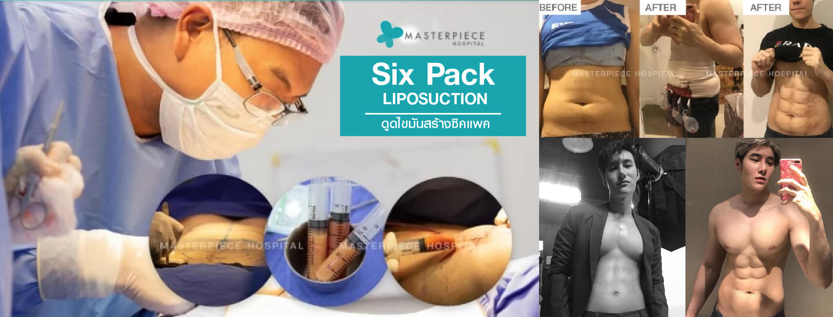 ดูดไขมันซิกแพค (Six Pack Liposuction) กล้ามท้องแน่นสวยเราช่วยได้