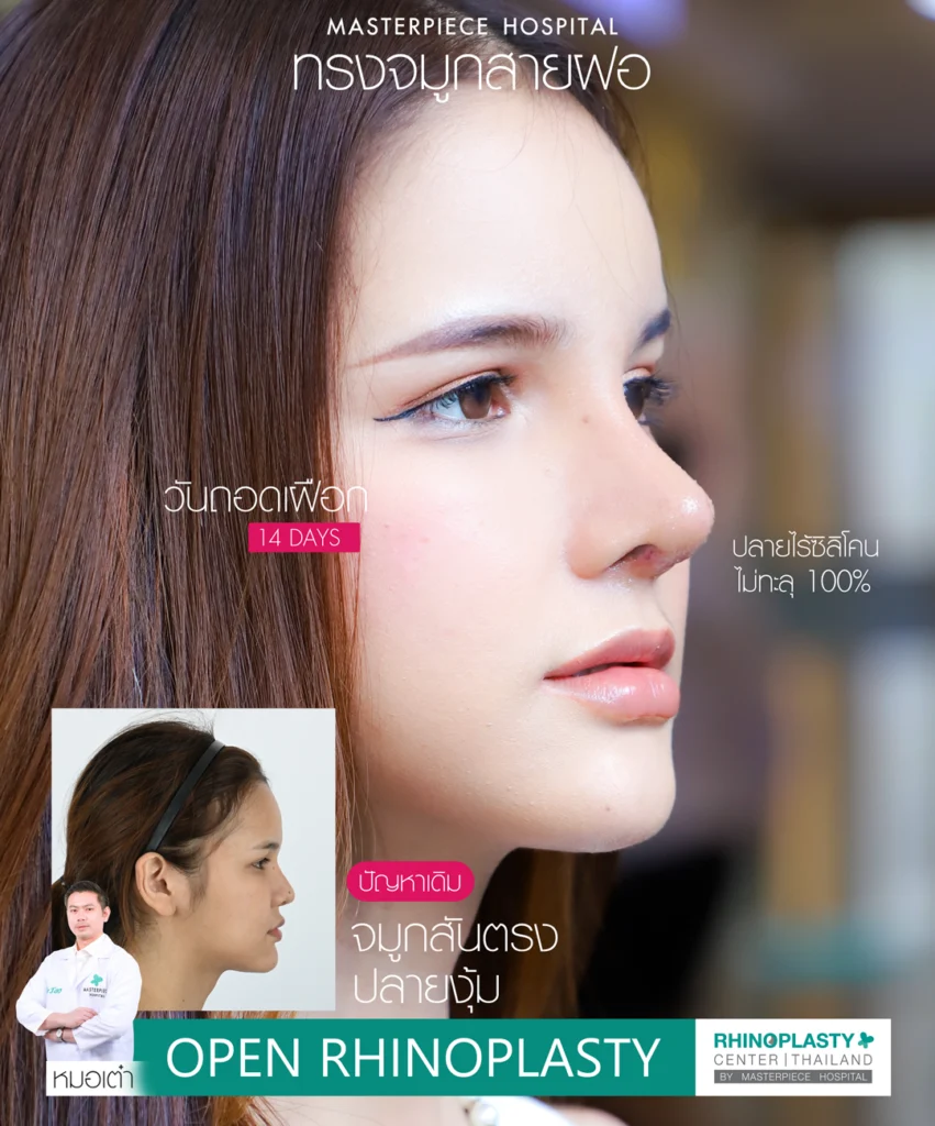 เสริมจมูก ทรงสวย เทคนิคทำจมูกมีกี่แบบ อันตรายไหม ข้อควรระวัง ...
